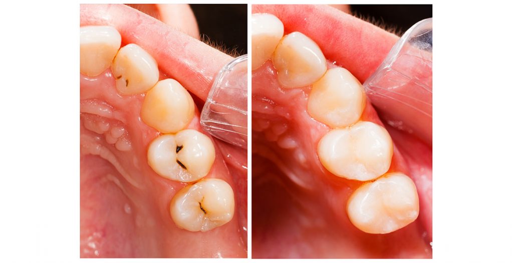 Restorations and Fillings Brisbane | Hawthorne Dental